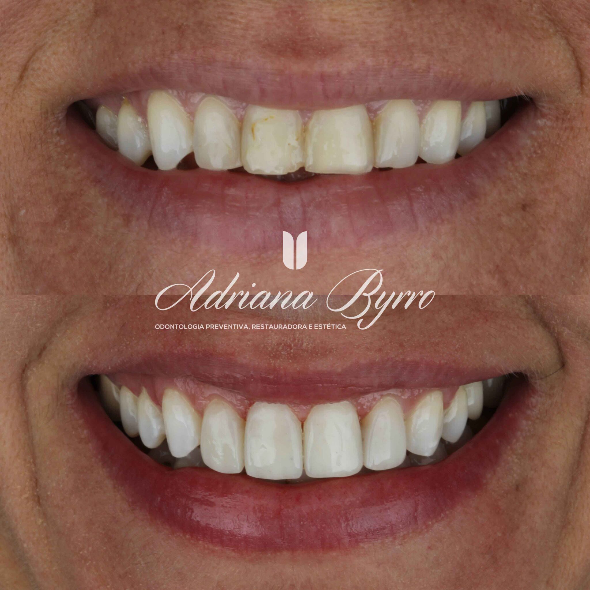 Tratamento de Mordida de Topo com Invisalign e Faceta de Resina – Jose ...