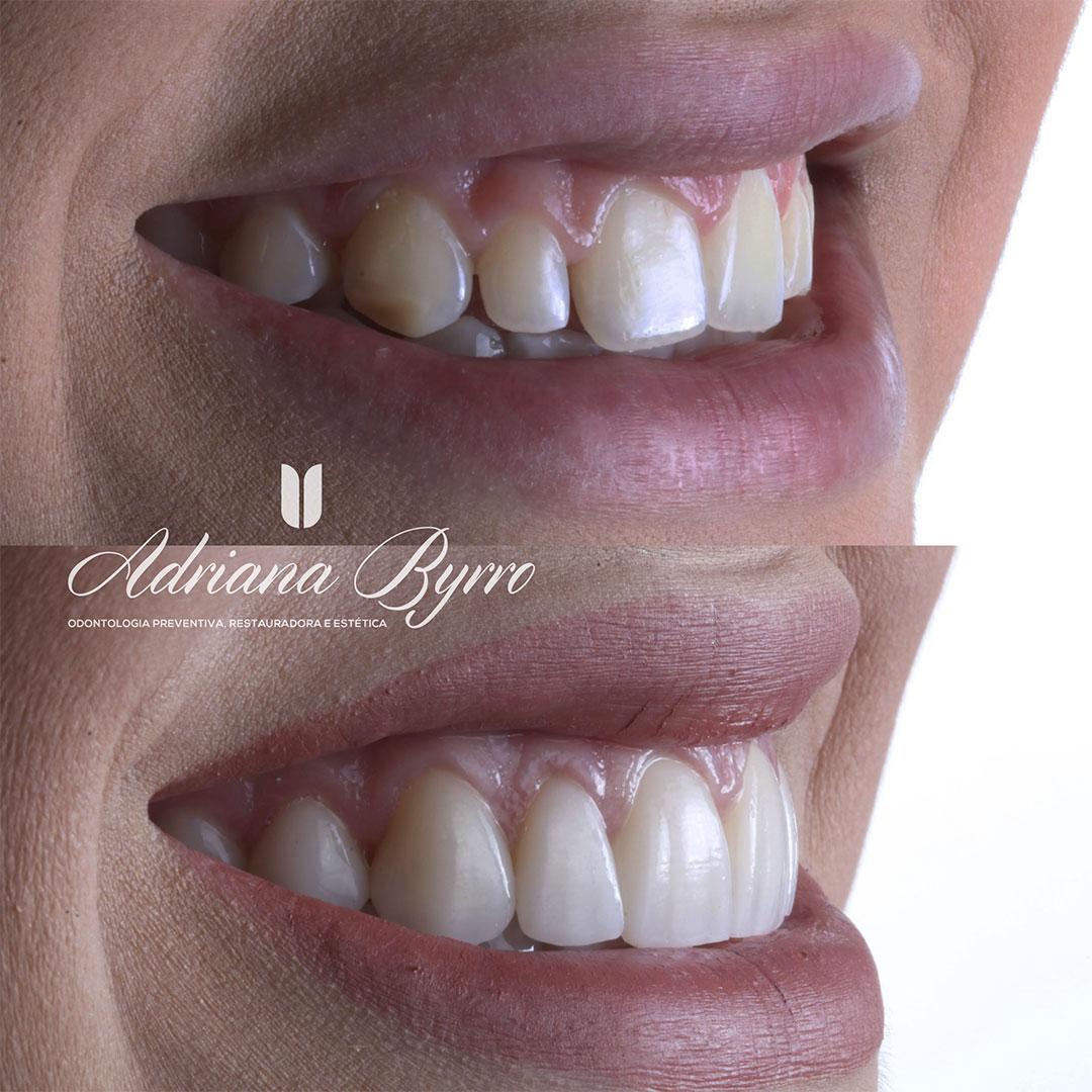 Facetas Dentárias: o que São, Para que Servem e Quais os Tipos - Jose ...